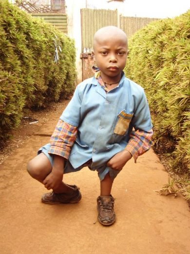 10 Most Shocking Leg Deformities - Booboone.com